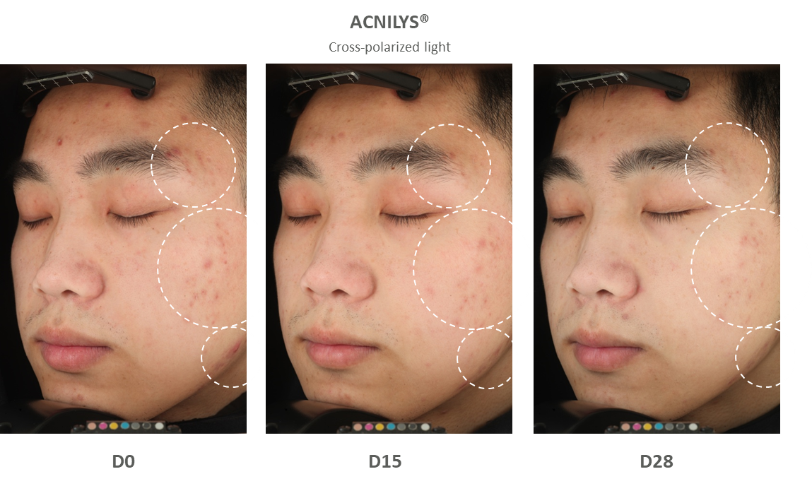 ACNILYS 桃金孃天然抗痘濃縮萃取 - CHEM GARDAN - 甲登企業