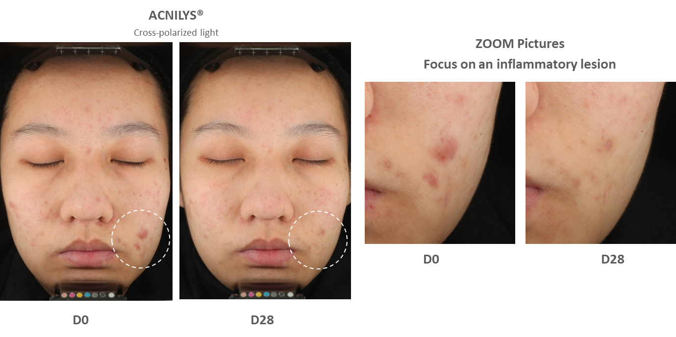 ACNILYS 桃金孃天然抗痘濃縮萃取 - CHEM GARDAN - 甲登企業